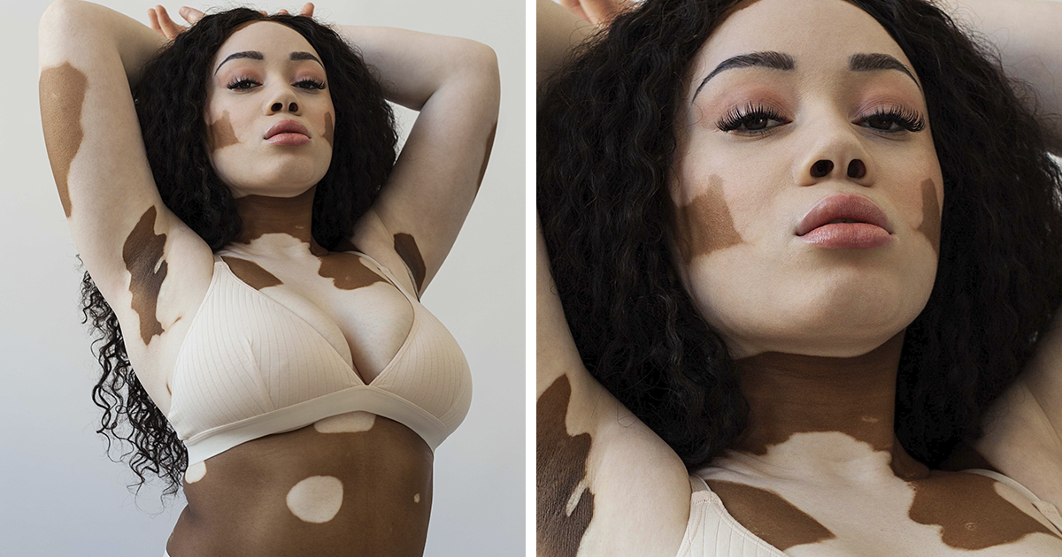 Photographer With Vitiligo Takes Pictures Of Other Women With The Same Condition (35 Pics ...