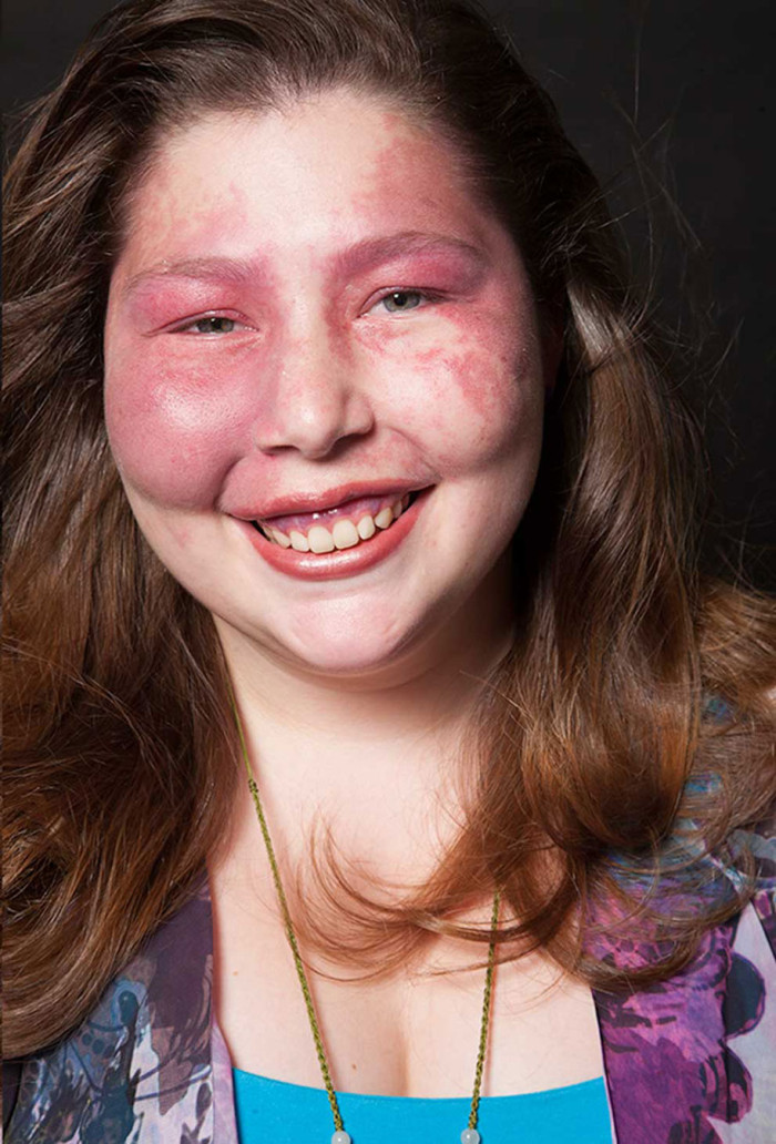 Photographer Quits Fashion To Photograph People With Genetic Conditions ...