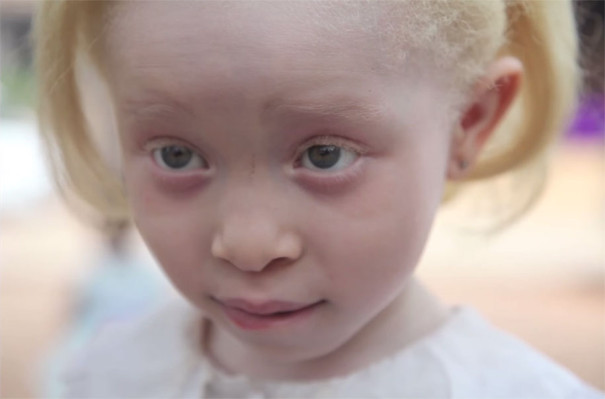 Photographer Quits Fashion To Photograph People With Genetic Conditions ...