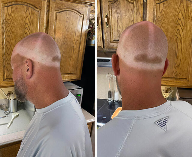 30 Times People Got Sunburns That Are Painful To Even Look At | DeMilked