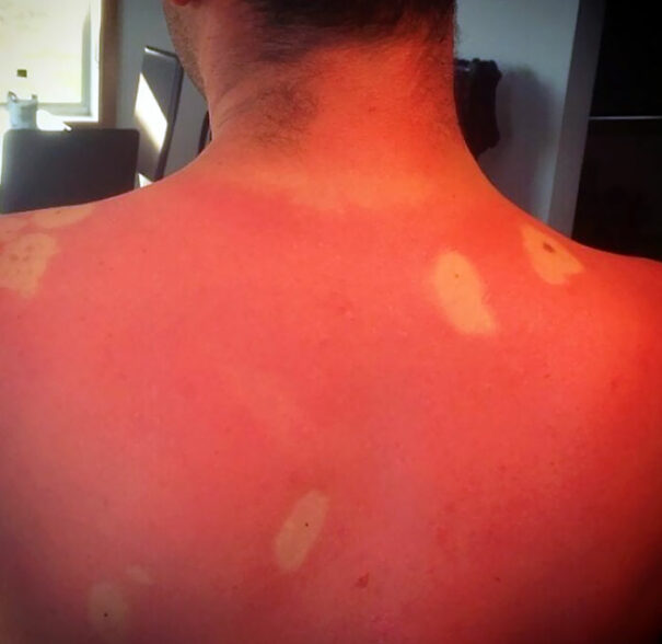 30 Times People Got Sunburns That Are Painful To Even Look At | DeMilked