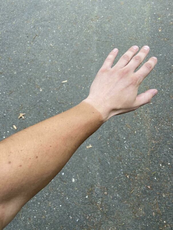 30 Times People Got Sunburns That Are Painful To Even Look At | DeMilked