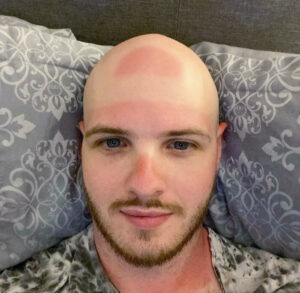 30 Times People Got Sunburns That Are Painful To Even Look At | DeMilked