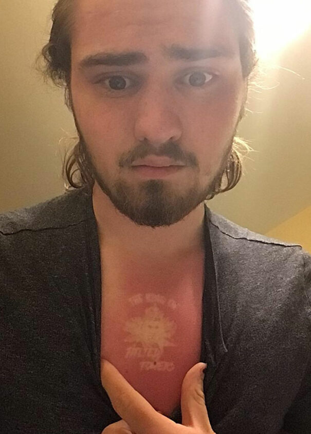 30 Times People Got Sunburns That Are Painful To Even Look At | DeMilked