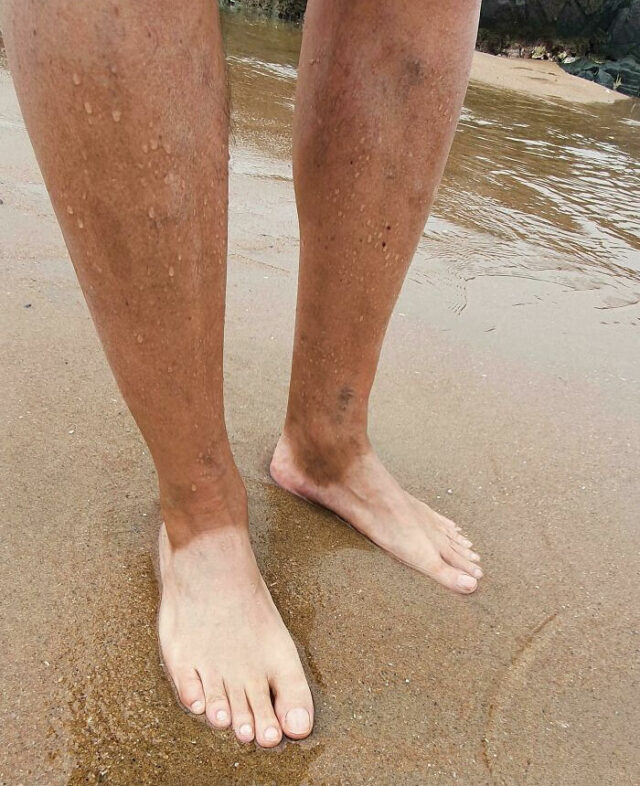 30 Times People Got Sunburns That Are Painful To Even Look At | DeMilked