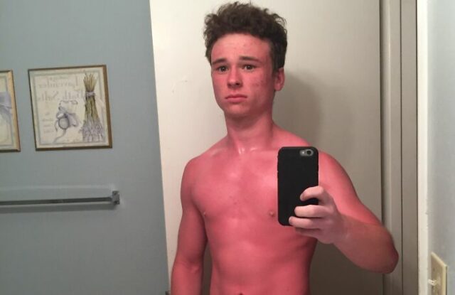 30 Times People Got Sunburns That Are Painful To Even Look At | DeMilked