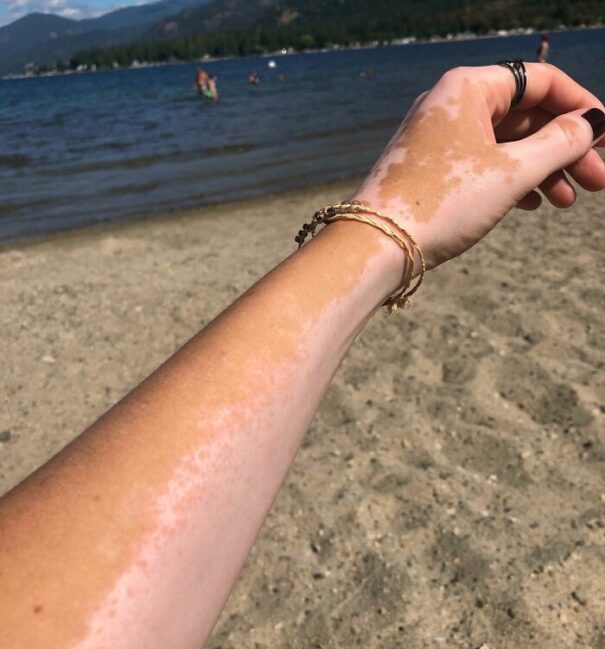 42 People Who Genetically Have Unique Body Characteristics | DeMilked