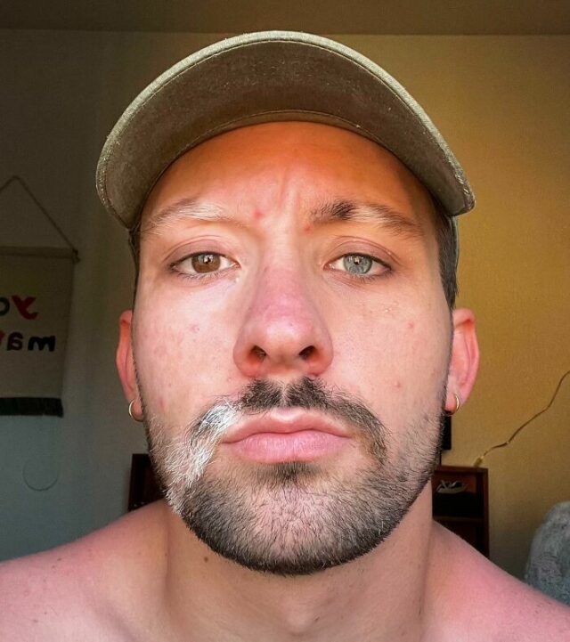 42 People Who Genetically Have Unique Body Characteristics | DeMilked