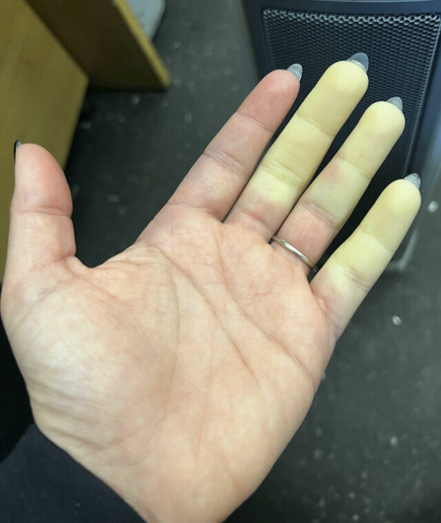 42 People Who Genetically Have Unique Body Characteristics | DeMilked