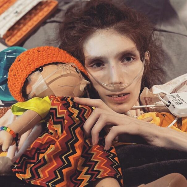 25 Dolls Crafted To Represent Children With Rare Conditions | DeMilked