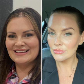 35 People Share Comparison Pics Of Their Before-And-After “Ozempic ...